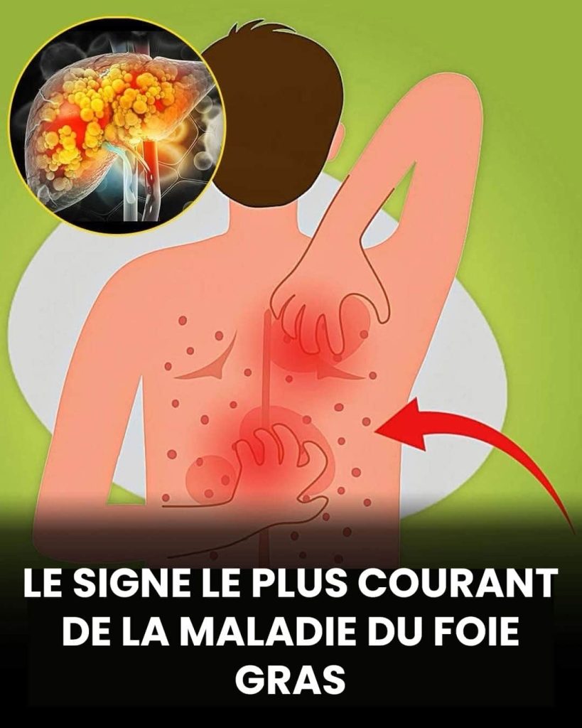 Protégez votre foie : comprendre les dangers de l'accumulation de ...