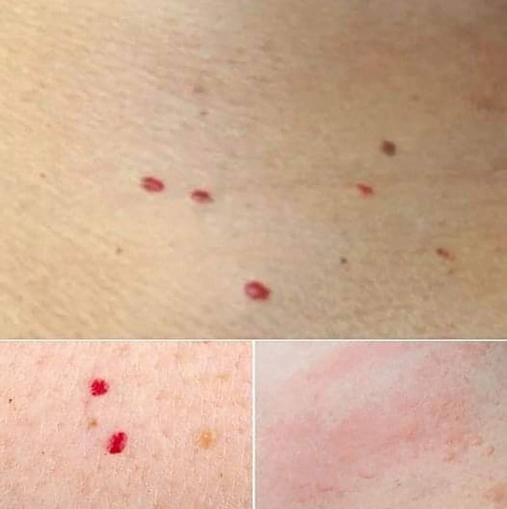 Que révèlent ces minuscules points rouges sur votre peau ? - Pratiques ...