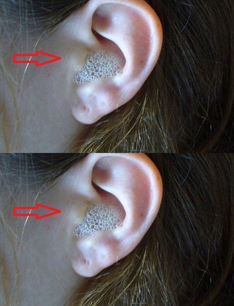 Trois gouttes, une oreille légère : le secret d'un conduit auditif ...